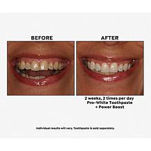 intelliWHiTE | Shop Teeth Whitening Kits, Toothpaste & Toothbrushes | HSN