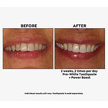 intelliWHiTE | Shop Teeth Whitening Kits, Toothpaste & Toothbrushes | HSN